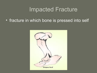 Bone Fractures | PPT