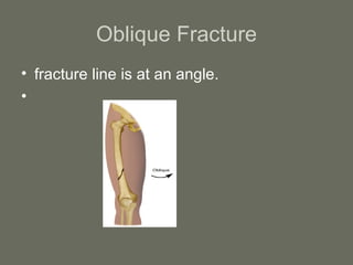 Bone Fractures | PPT