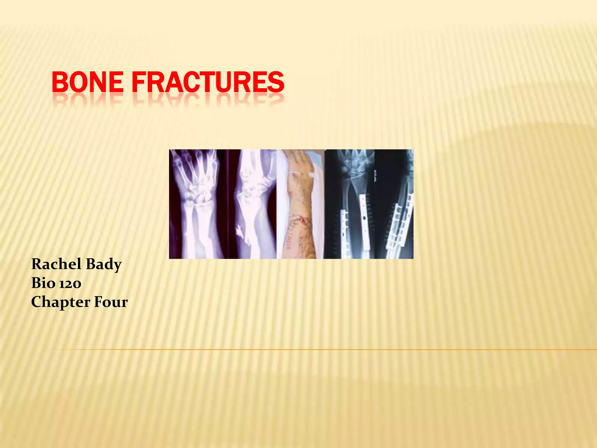 Bone Fractures | PPT