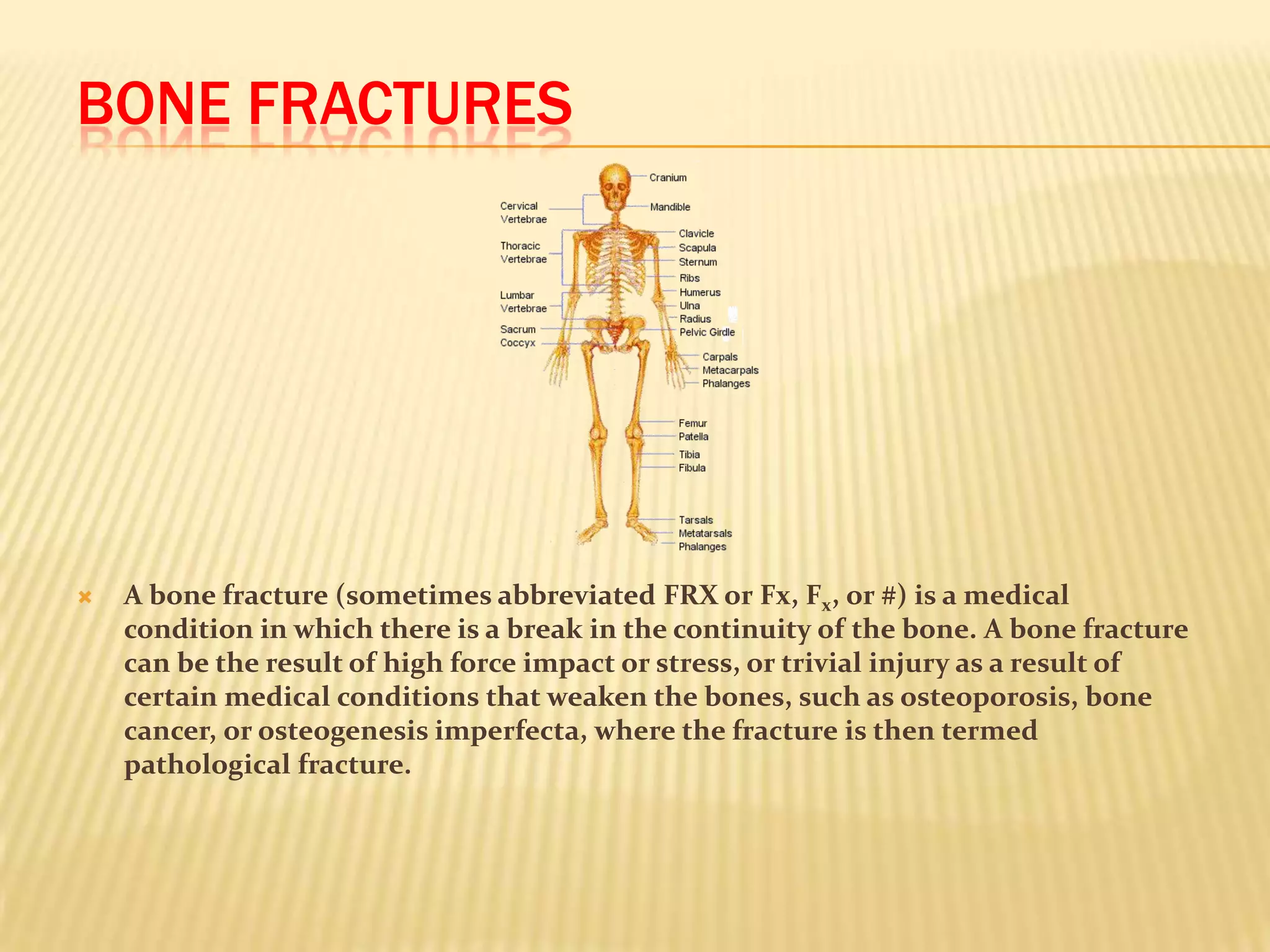 Bone Fractures | PPT