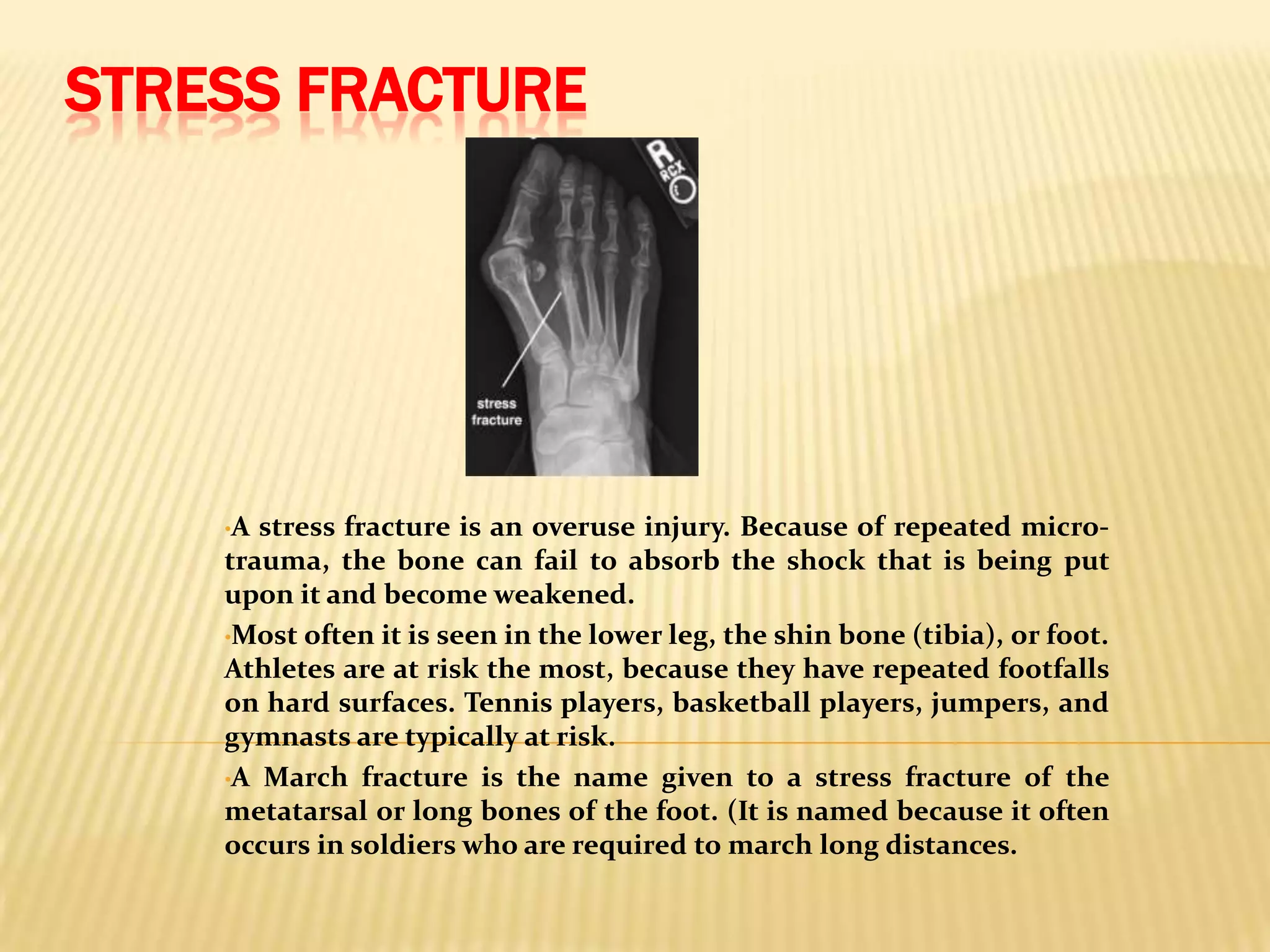 Bone Fractures | PPT