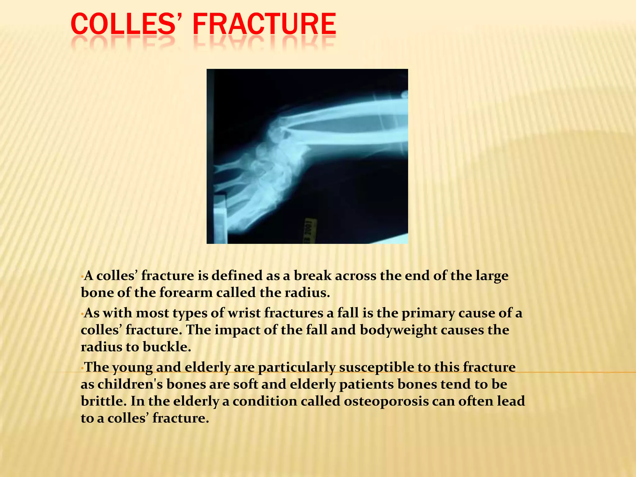 Bone Fractures | PPTX