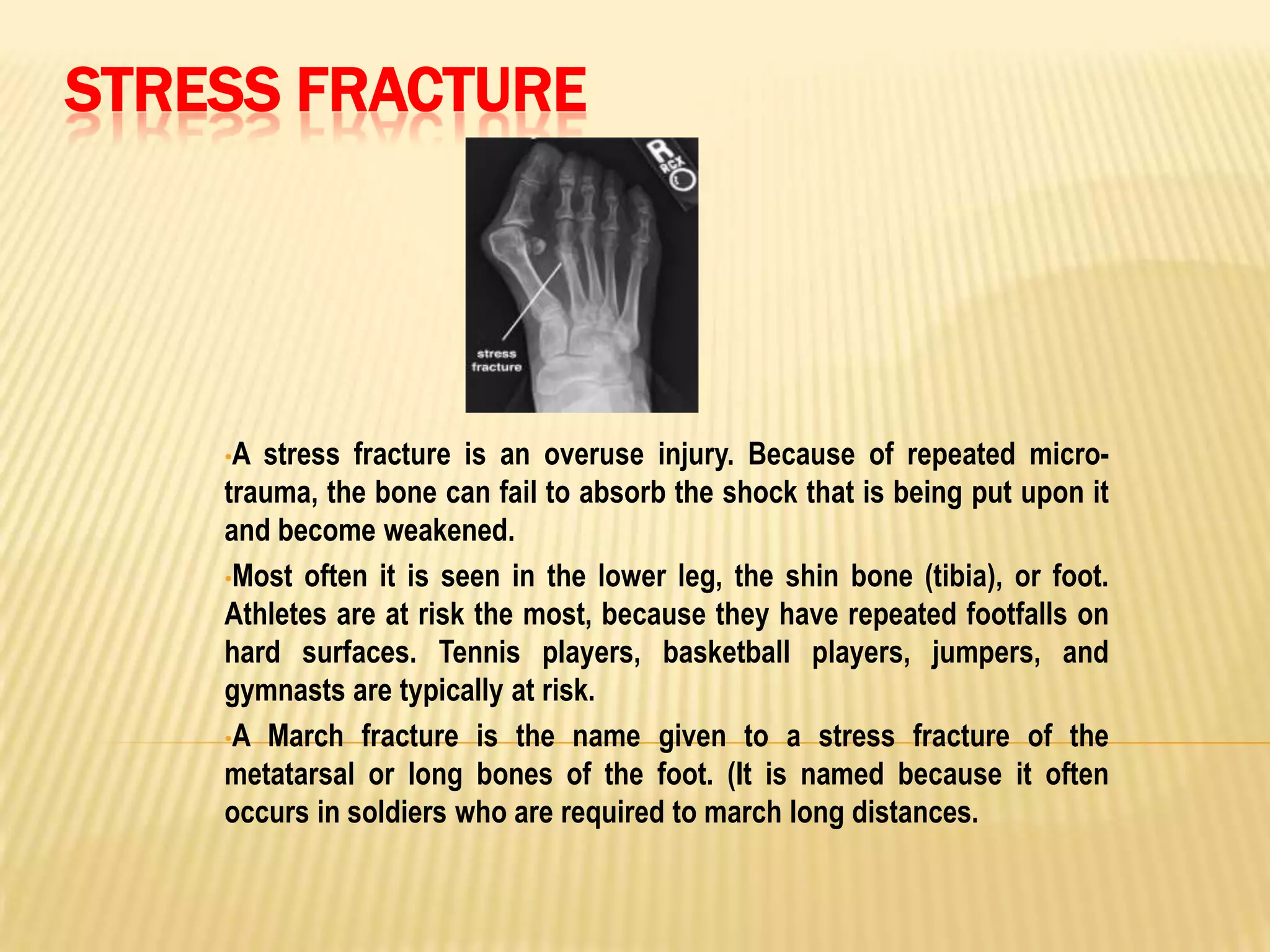 Bone Fractures | PPTX