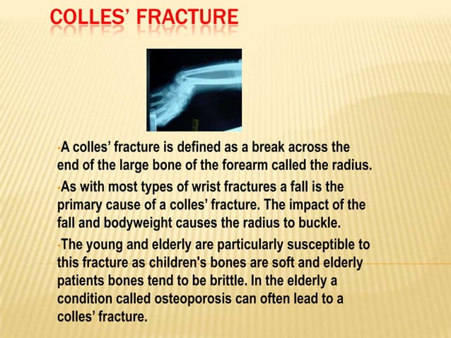 Bone Fractures | PPTX