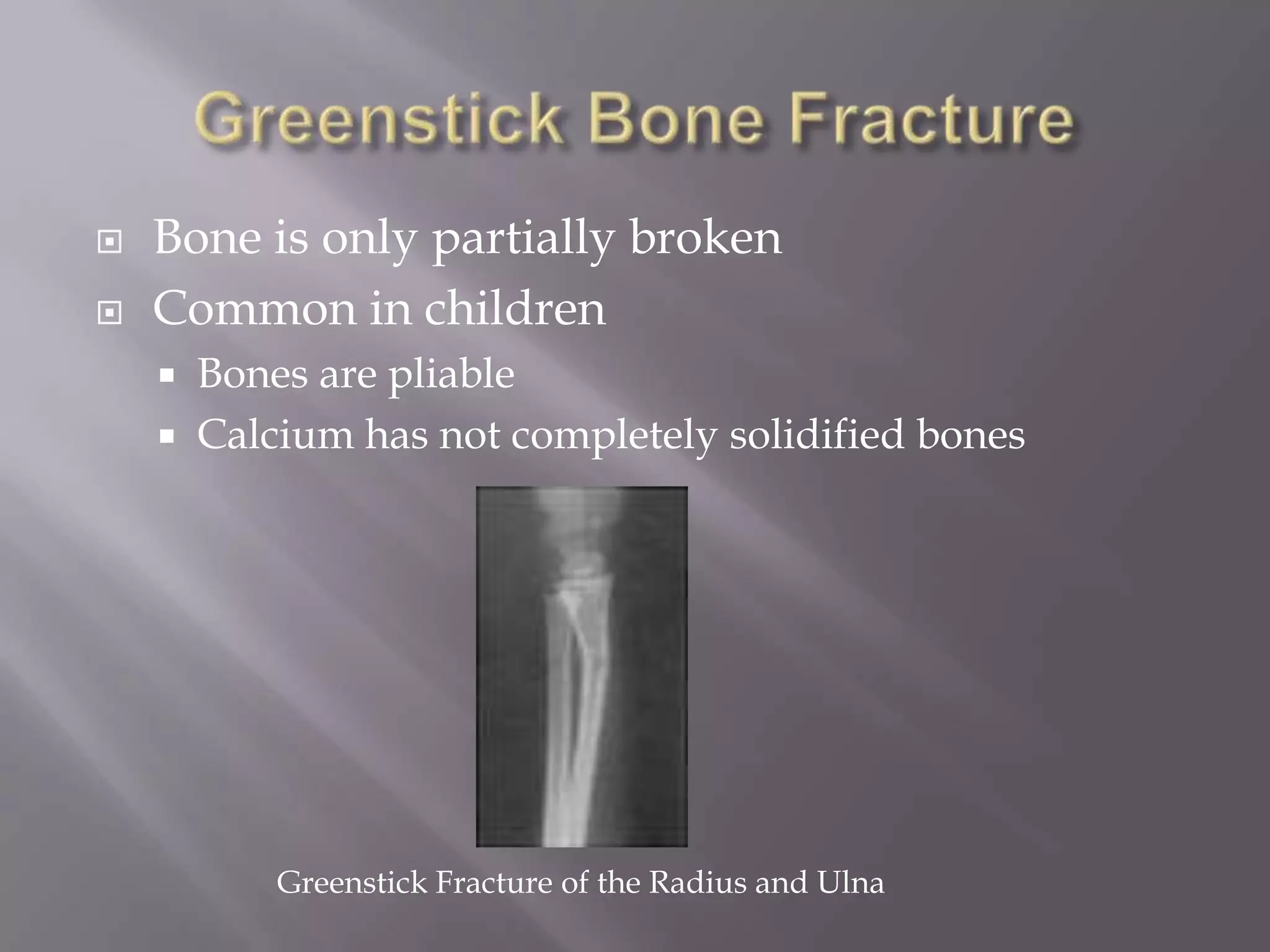Bone Fractures | PPTX