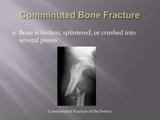 Bone Fractures | PPTX