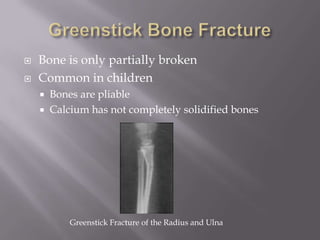 Bone Fractures | PPTX
