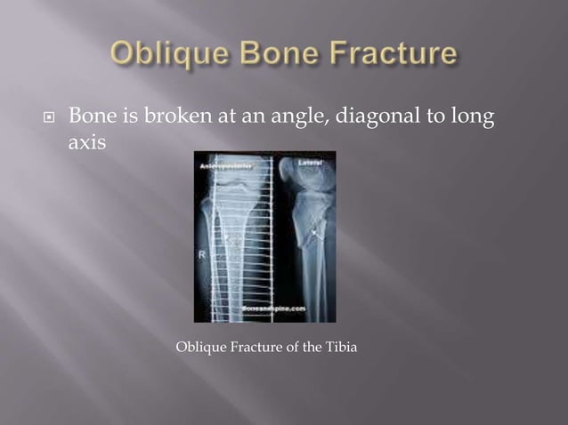 Bone Fractures | PPTX