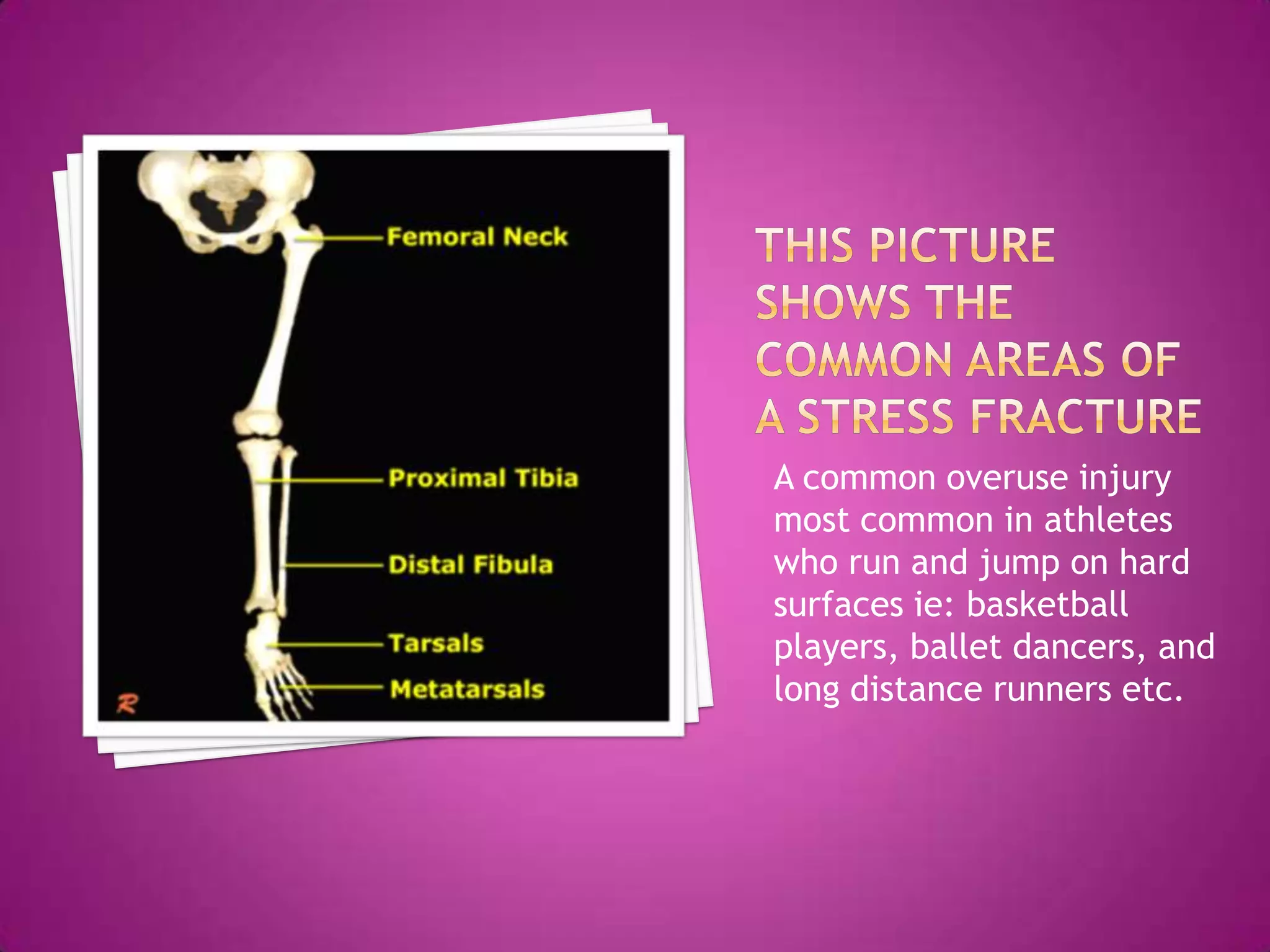 Bone Fractures | PPT