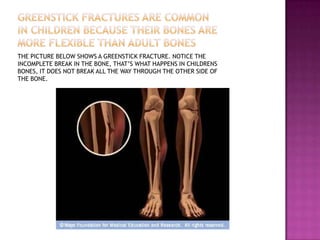 Bone Fractures | PPTX