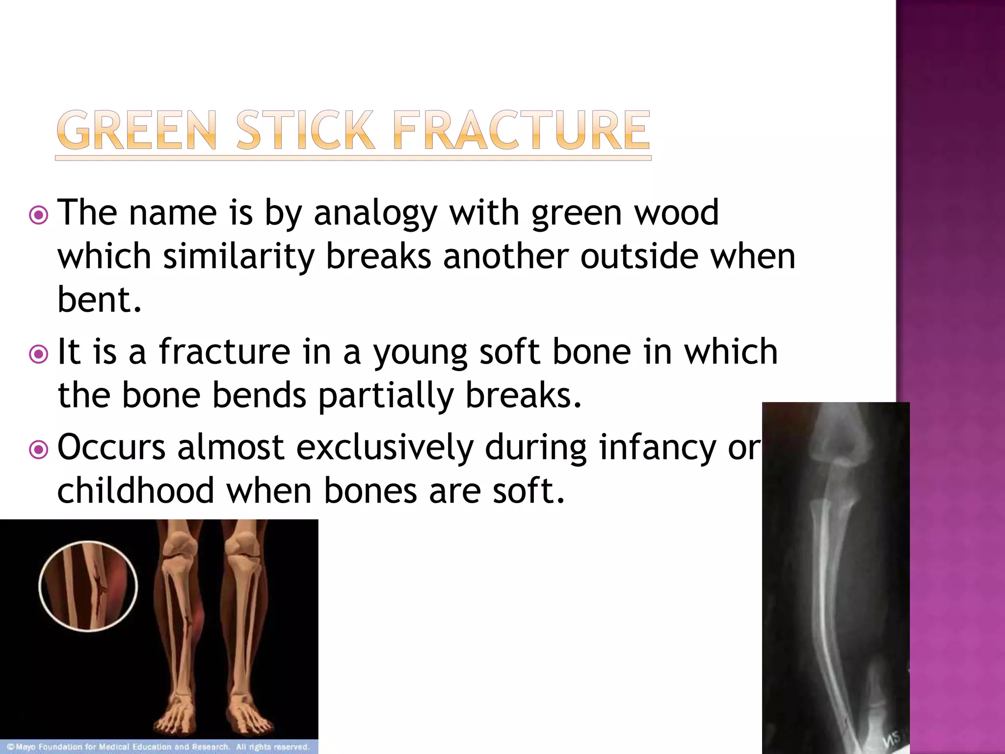 Bone Fractures | PPTX