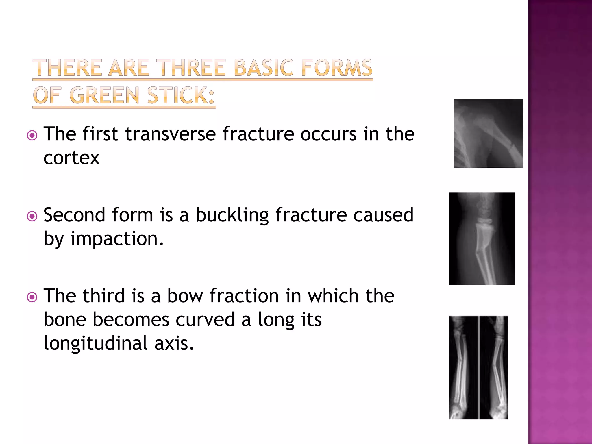 Bone Fractures | PPT | Free Download