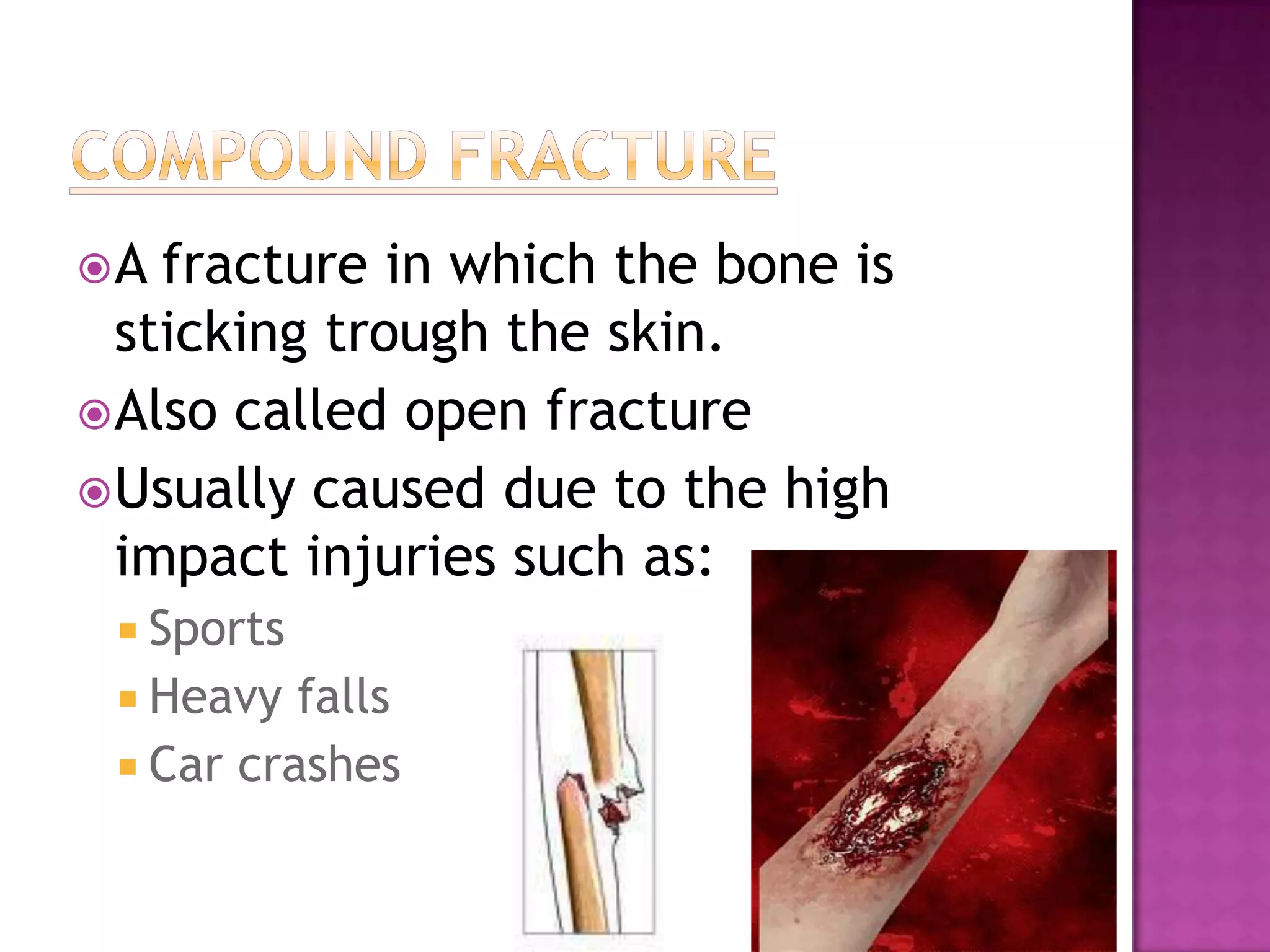 Bone Fractures | PPTX