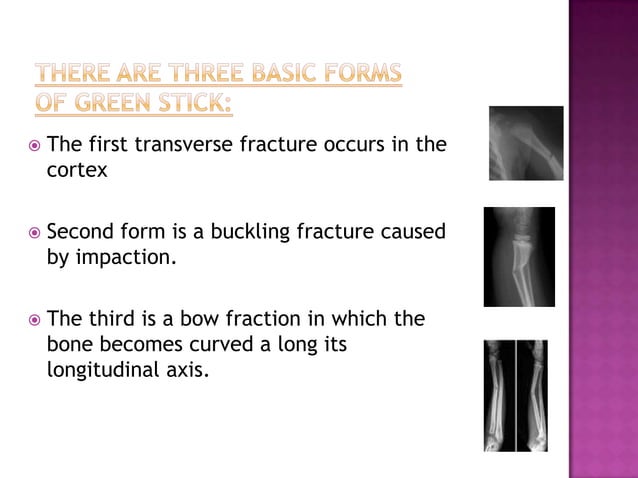 Bone Fractures | PPTX