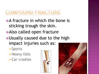 Bone Fractures | PPTX