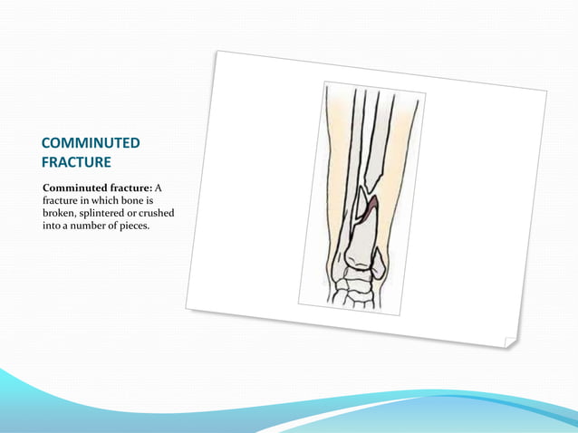 Bone fractures | PPT