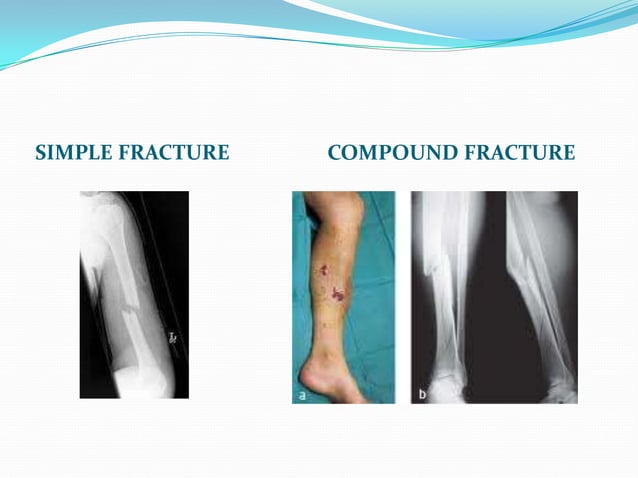 Bone fractures | PPT