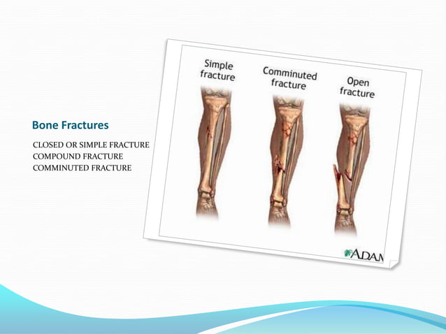 Bone fractures | PPT