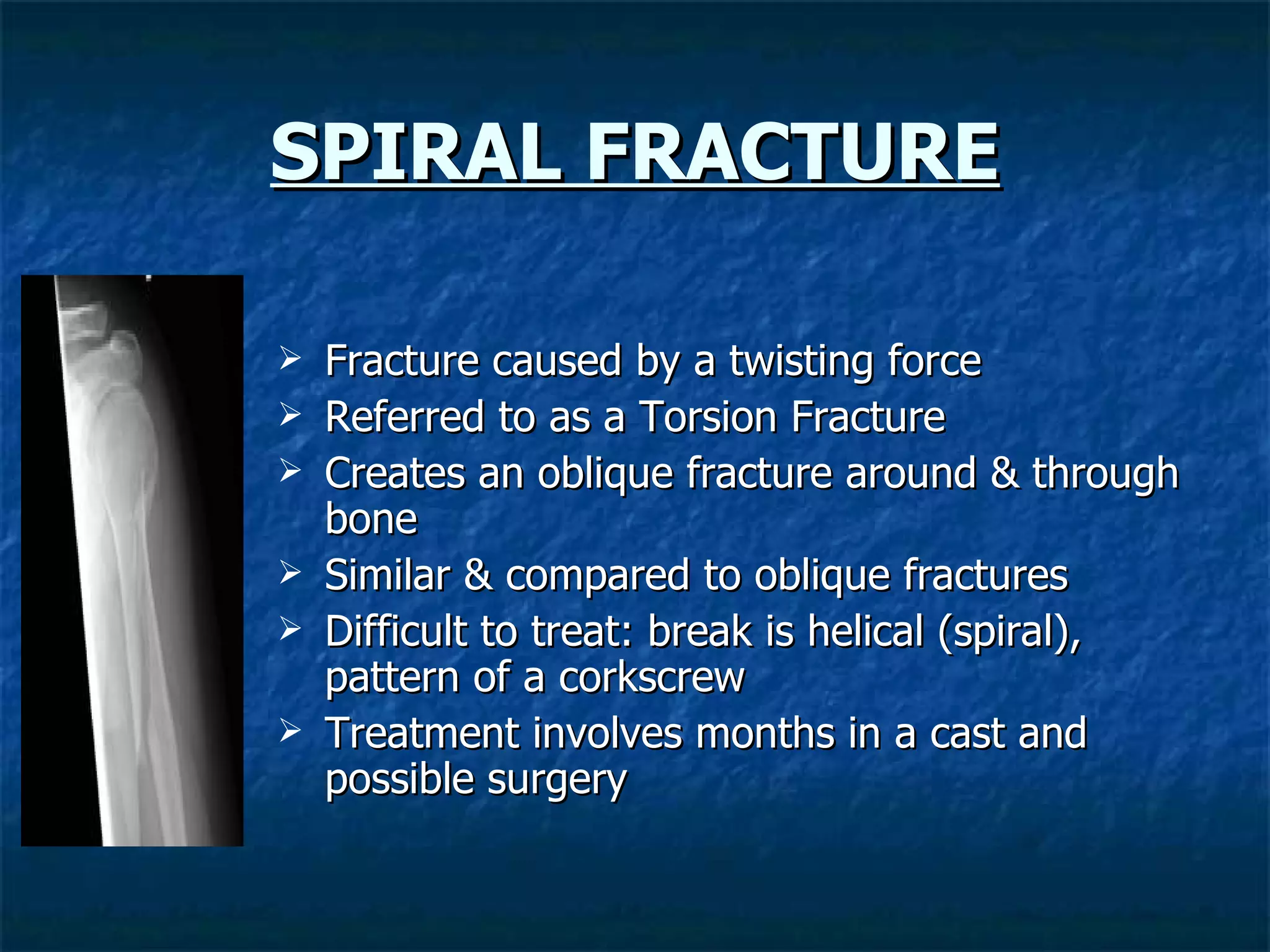 Bone fractures | PPT