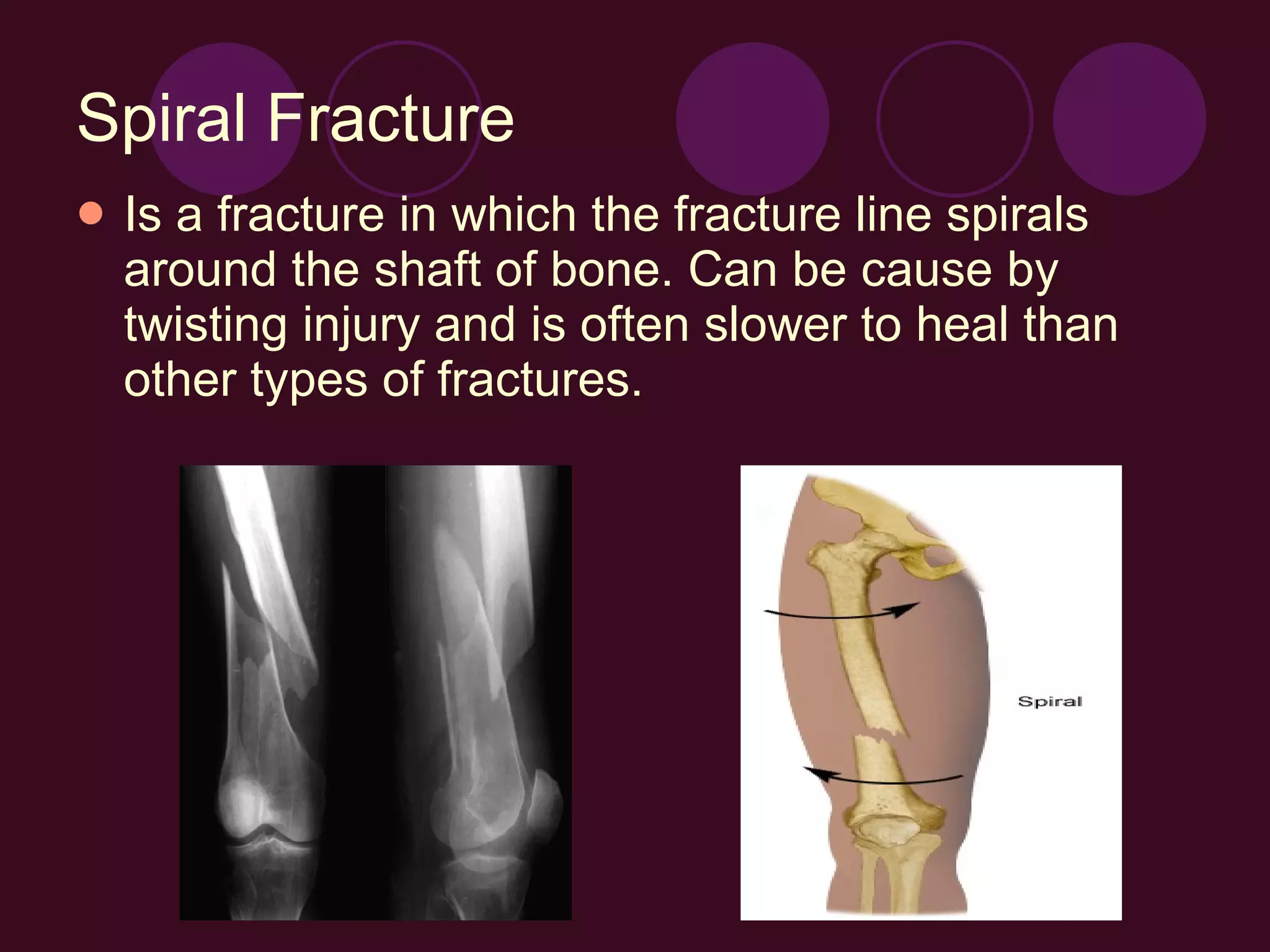 Bone fractures#4presentation | PPT