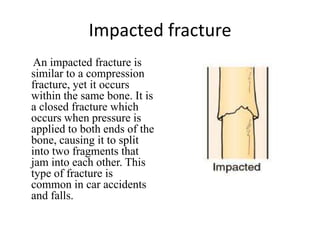 Bone fractures power point | PPTX