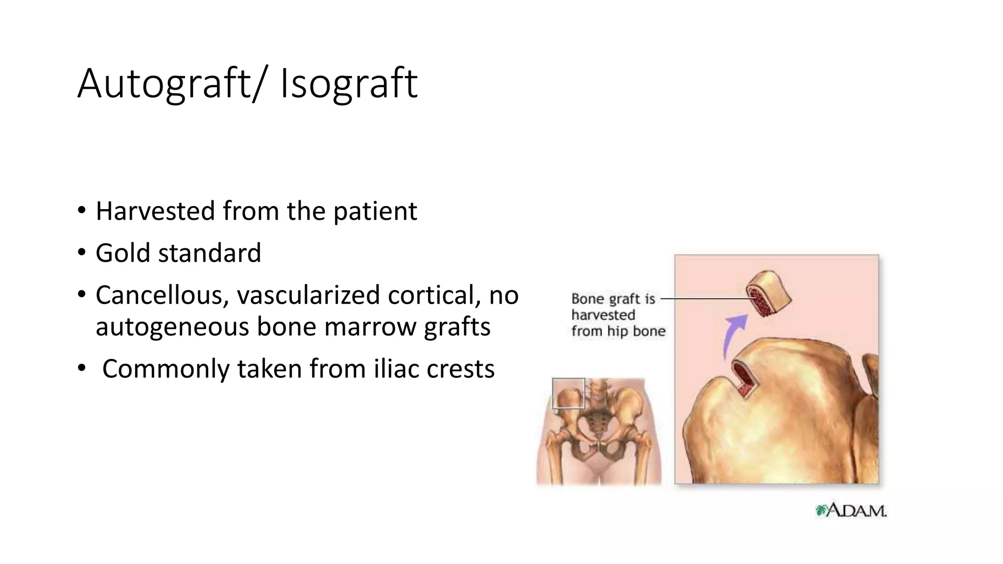 Bone graft and its substitute | PPTX