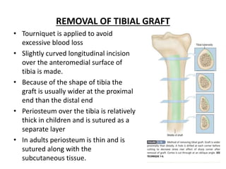 Bone grafting | PPTX