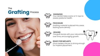 Understanding Bone Grafting for Implants | PDF
