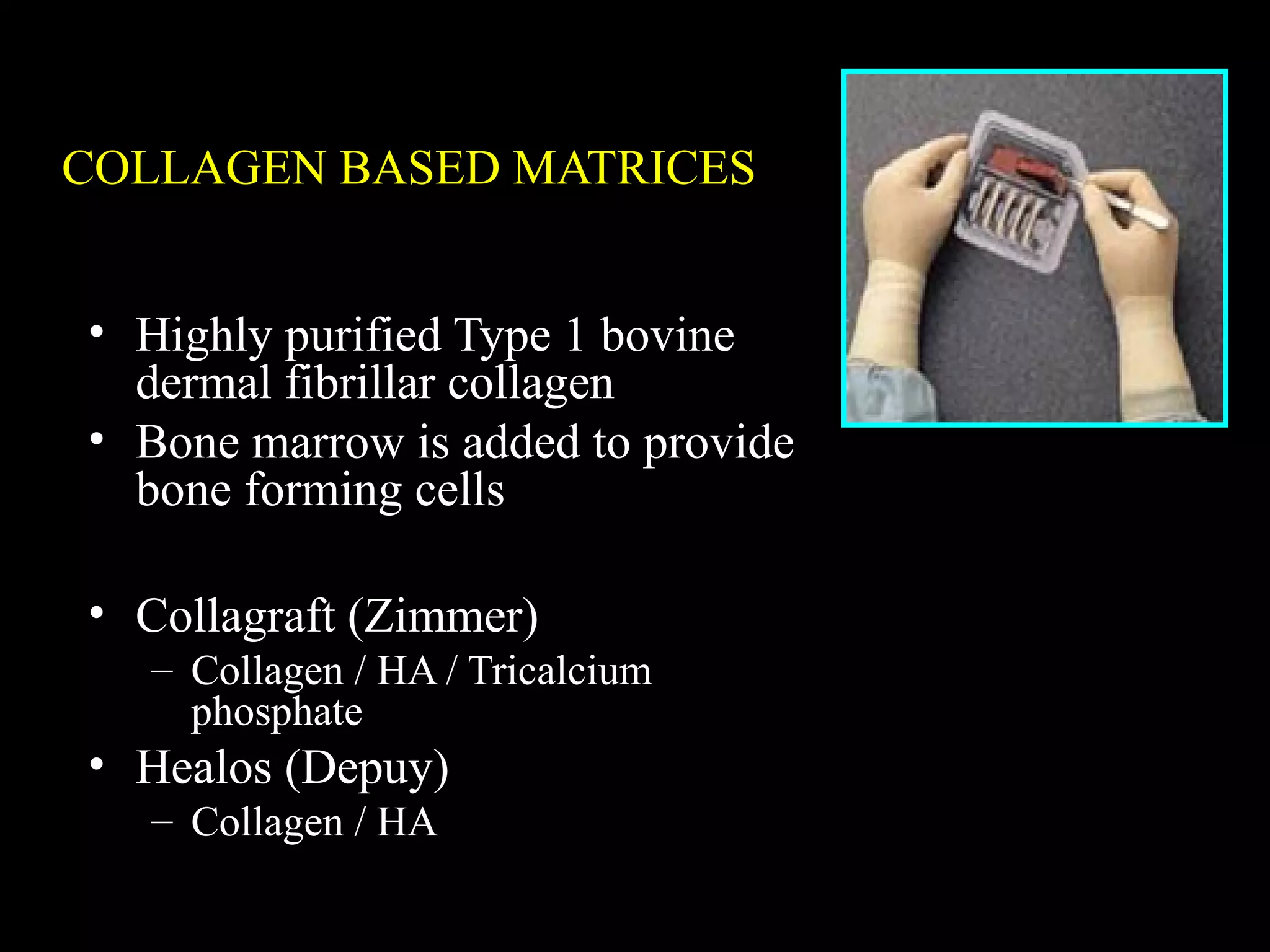 Bone grafting and bone graft substitutes | PPT