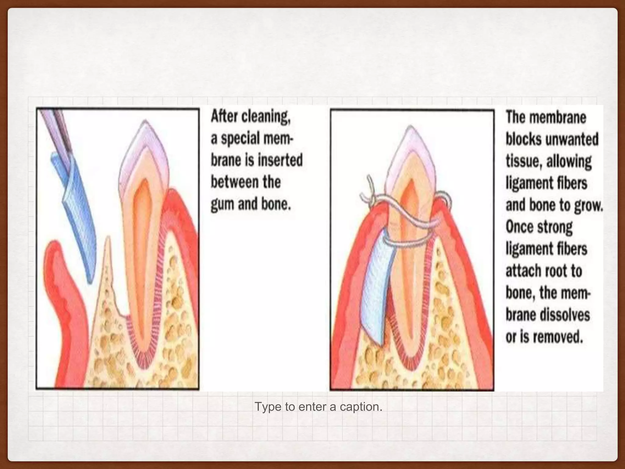 Bone Graft in Periodontal Treatment | PPT