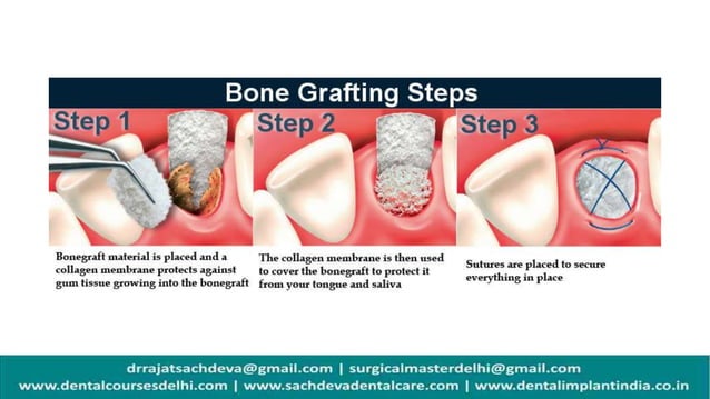 Bone graft materials | Bone grafting in Implantation | Periodontal ...