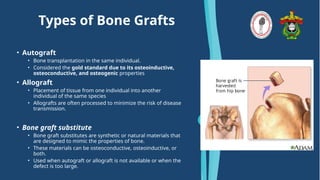 Bone Graft Principles, Choices and Application.pptx