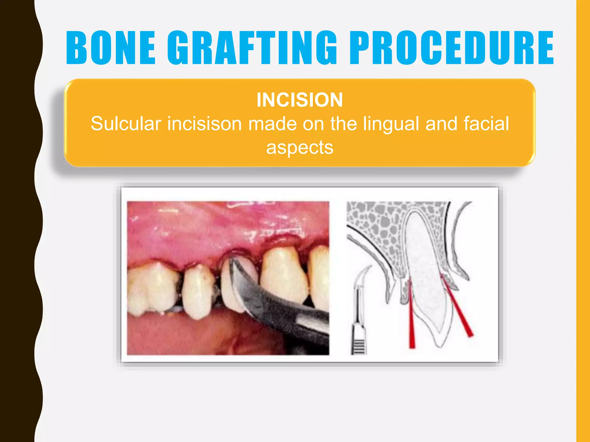 Bone grafts in dentistry | PPTX