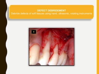 Bone grafts in dentistry | PPTX