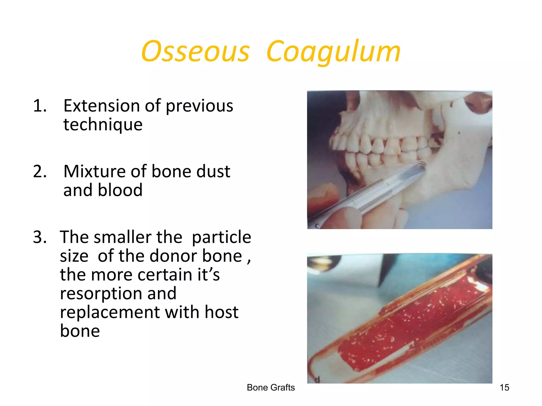 BONE GRAFTS.pptx