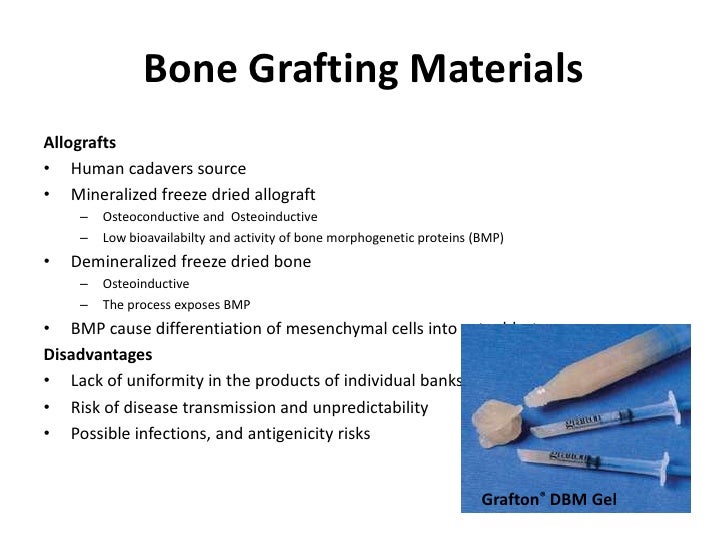 Bone grafts Engineering