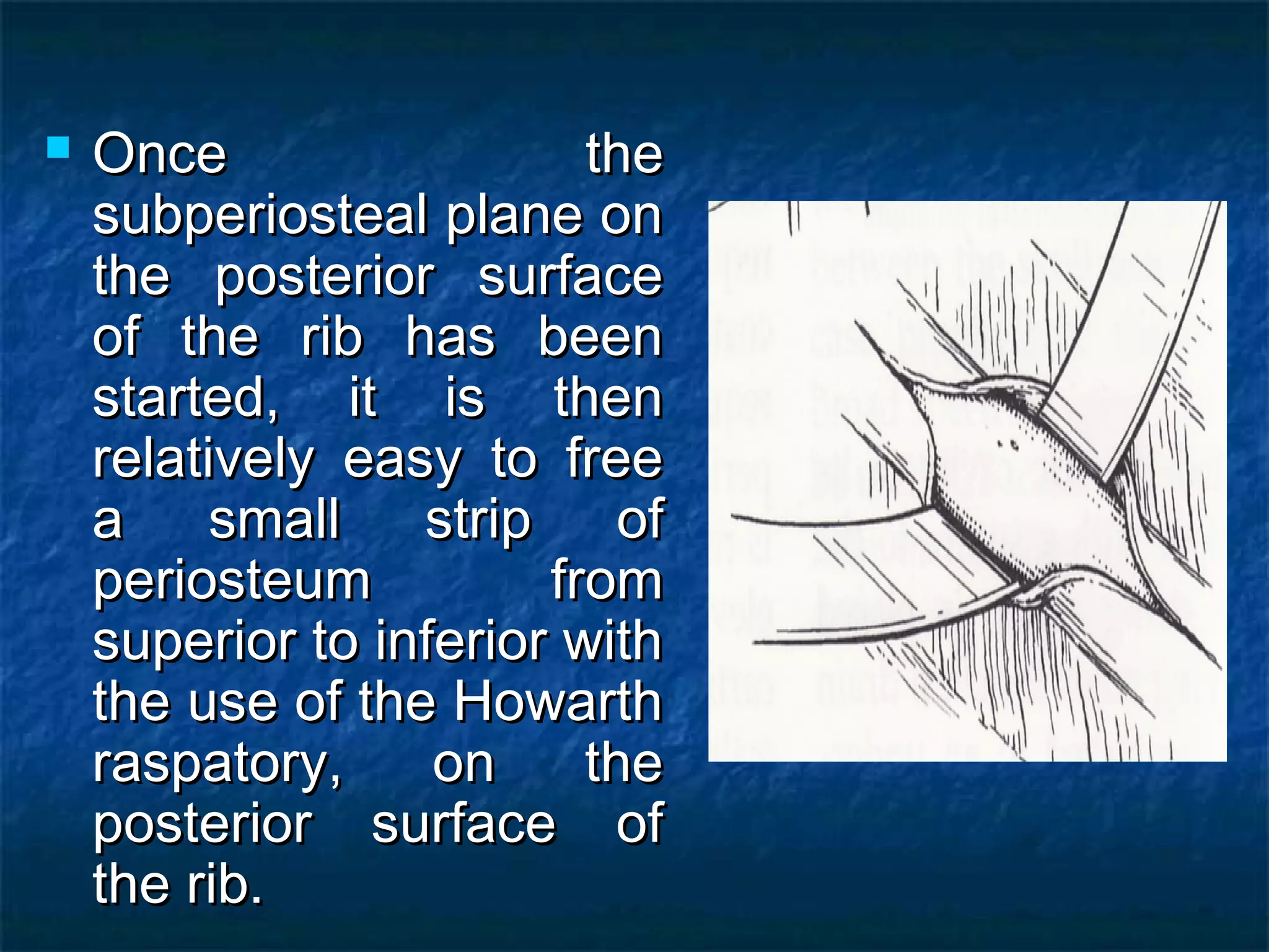 Bone grafts in oral surgery | PPT