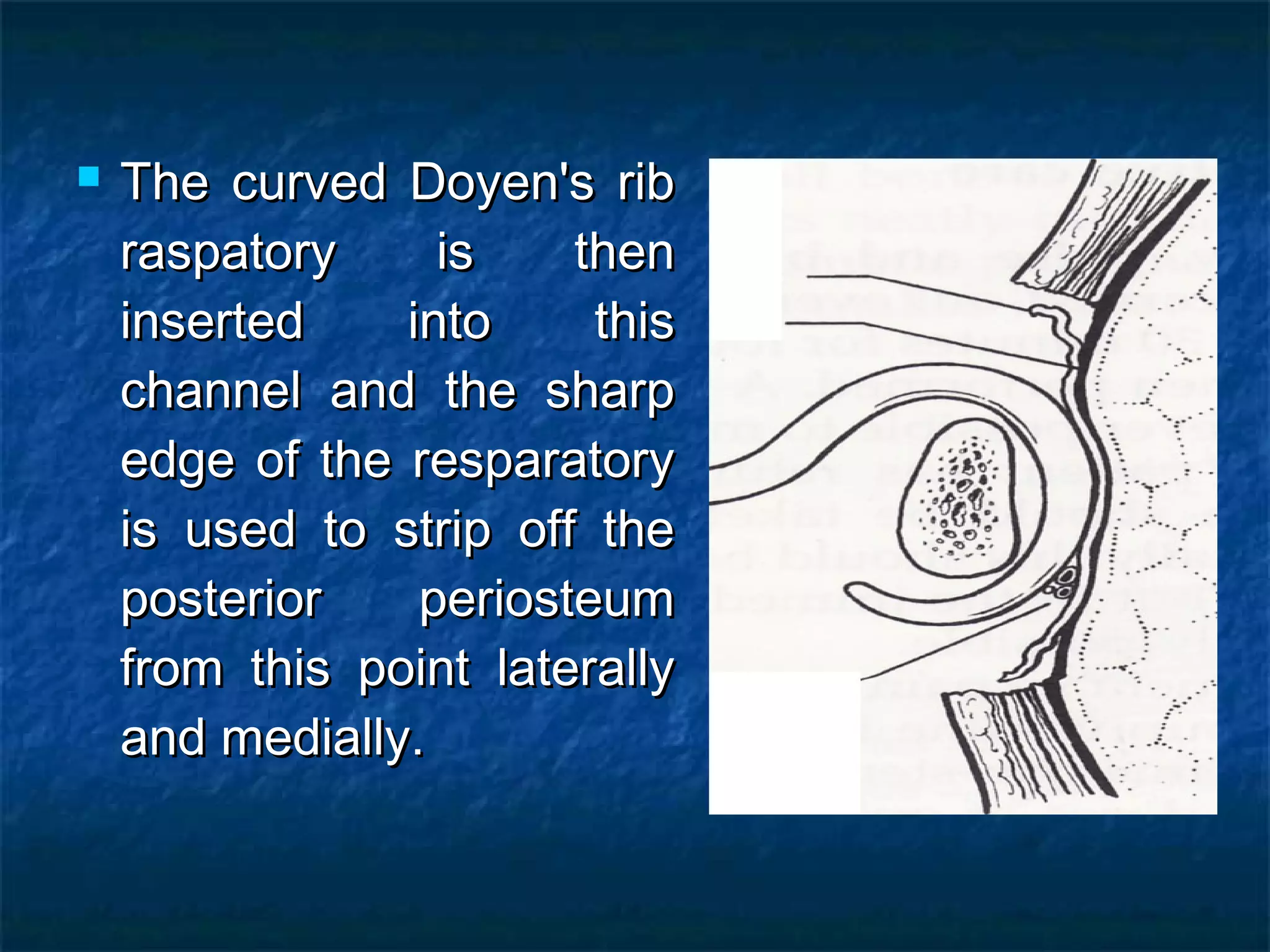 Bone grafts in oral surgery | PPT