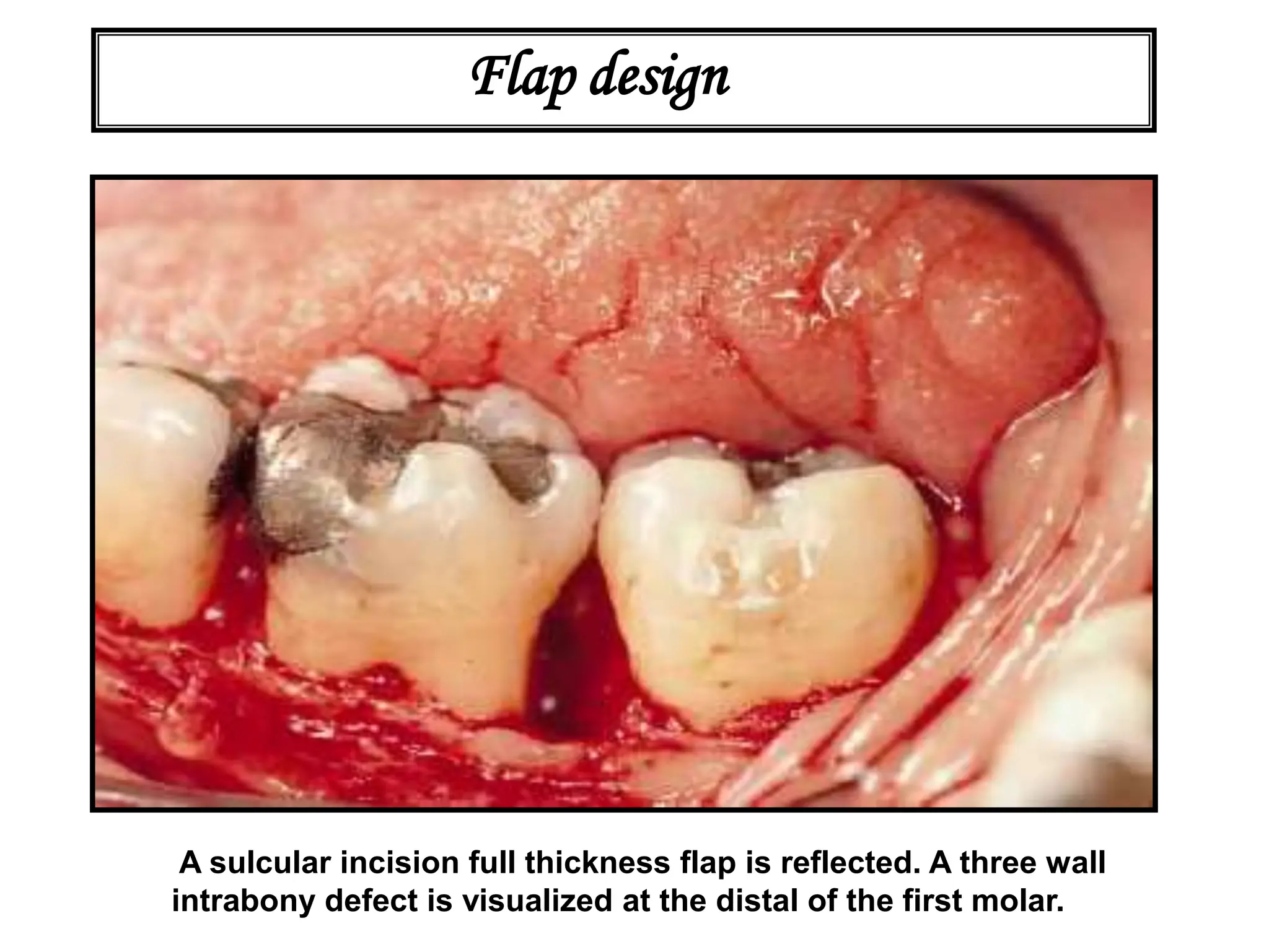 bone grafts for periodontal implants.ppt