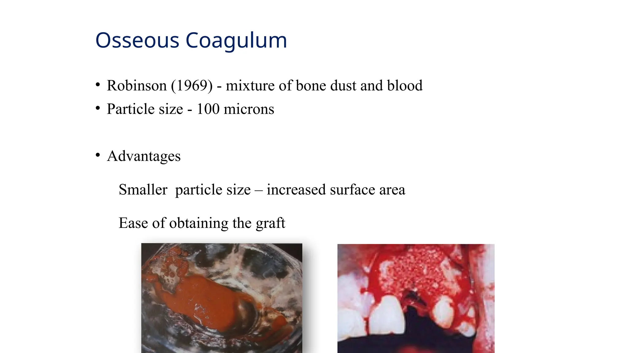 osseous bone grafts in periodontics.pptx