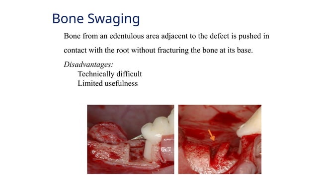 osseous bone grafts in periodontics.pptx