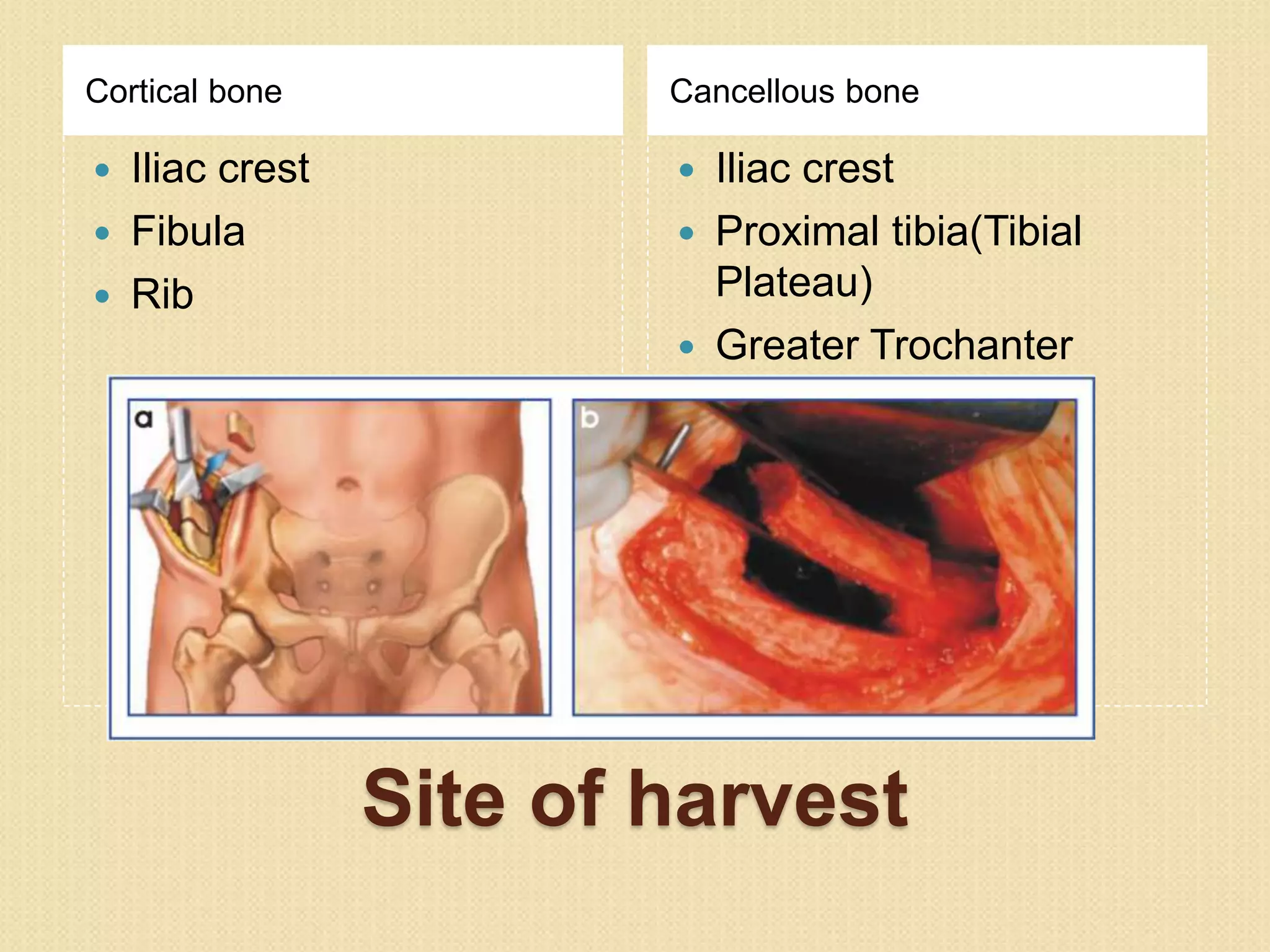 bone graft, substitute, BMP.ppt