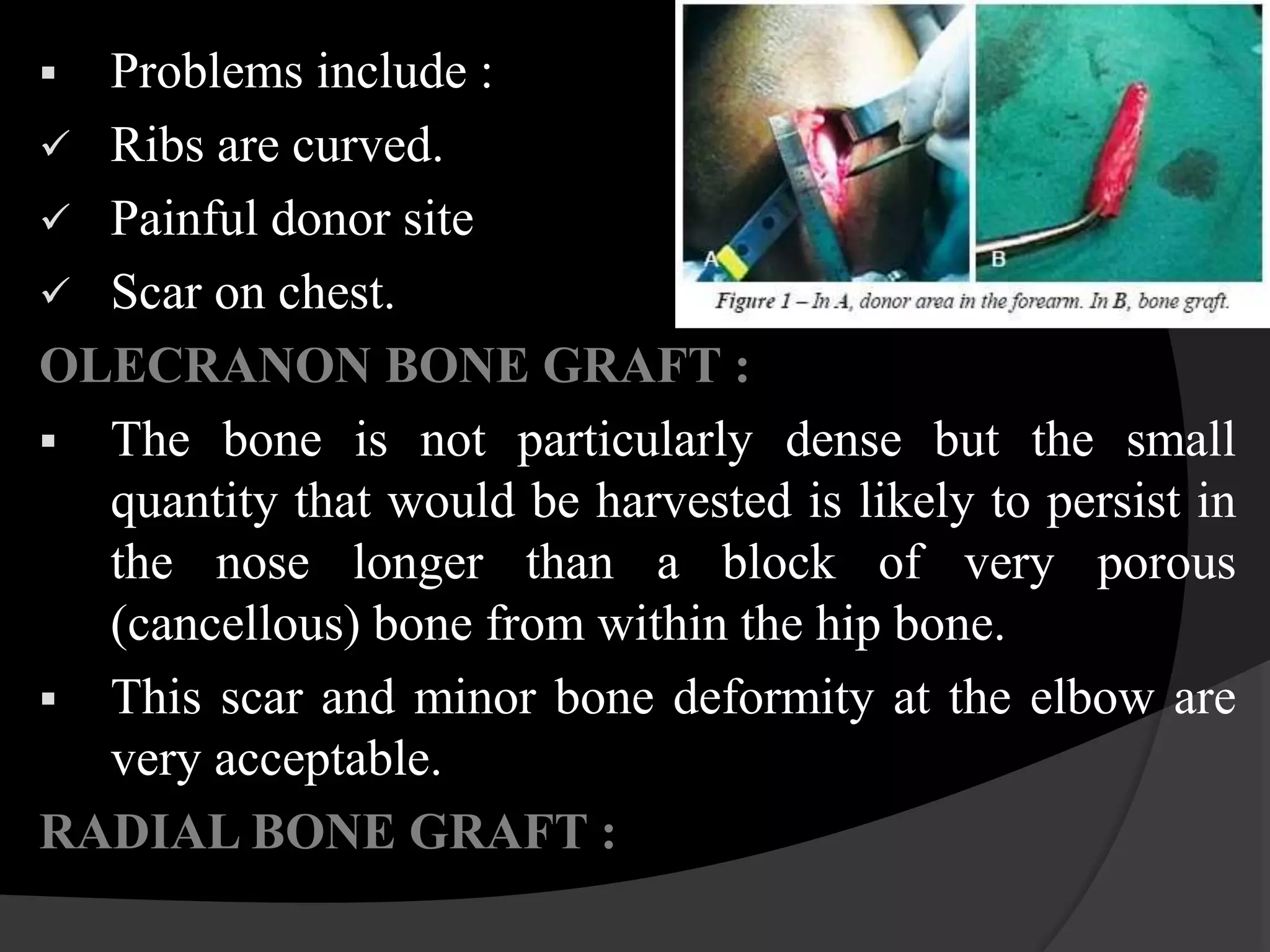bone_grafts_used_in_nasal_reconstruction.pptx