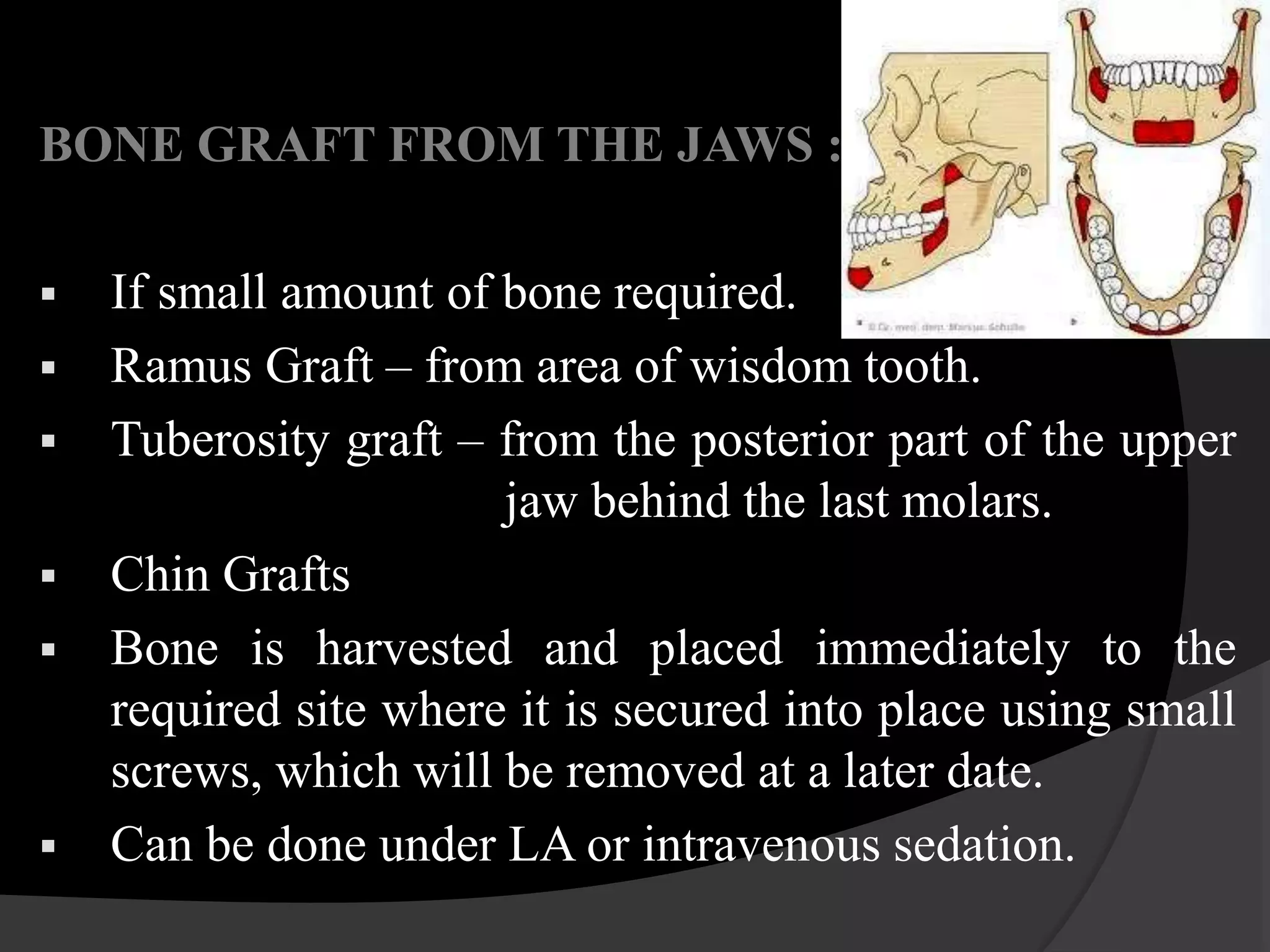 bone_grafts_used_in_nasal_reconstruction.pptx