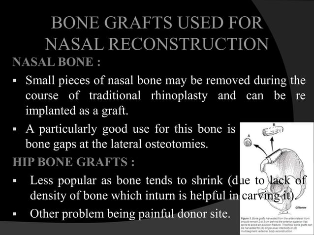 bone_grafts_used_in_nasal_reconstruction.pptx
