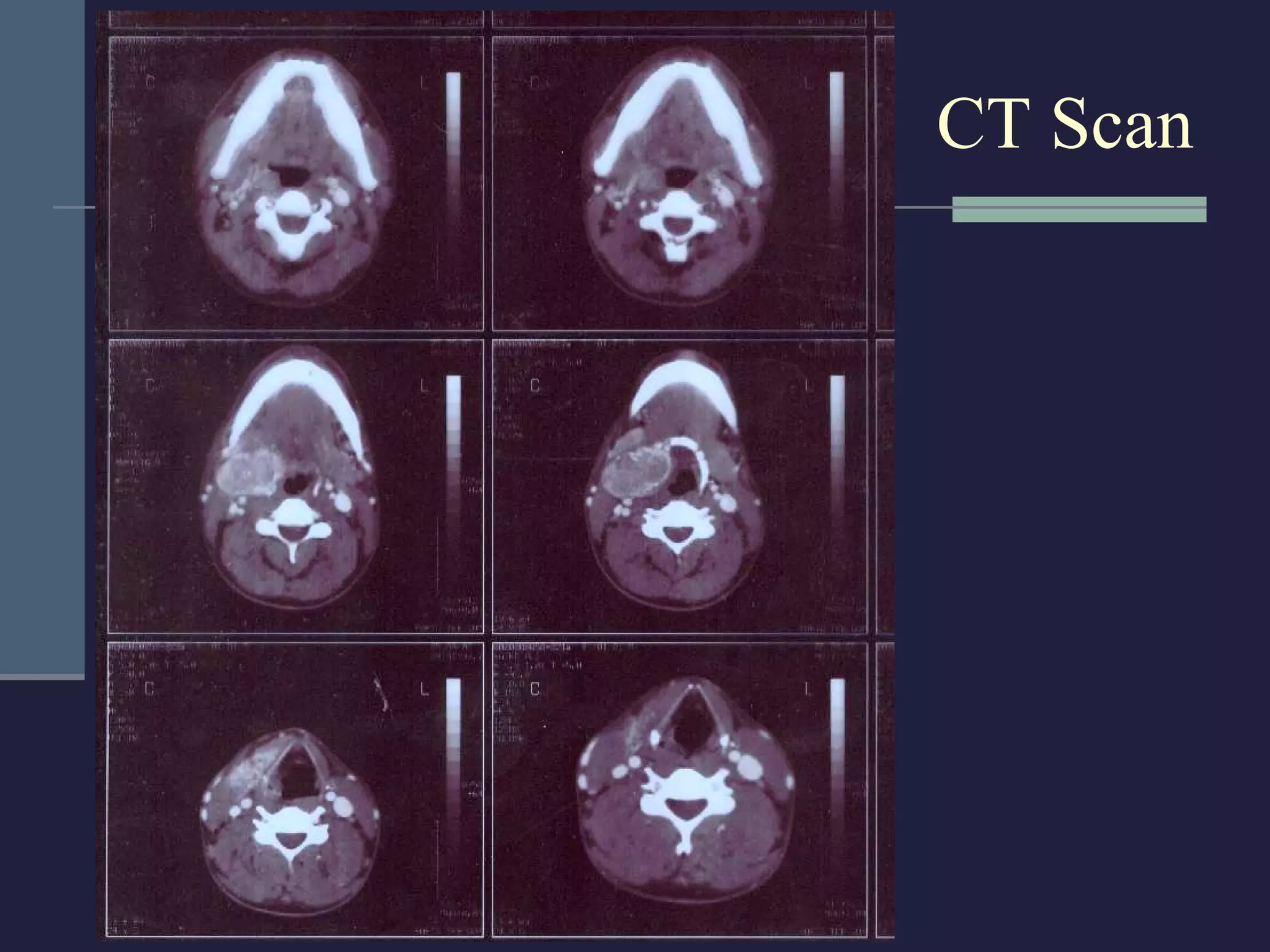 Bone haemangioma of hyoid bone | PPT