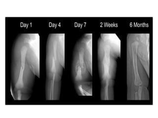 Bone Remodeling X Ray