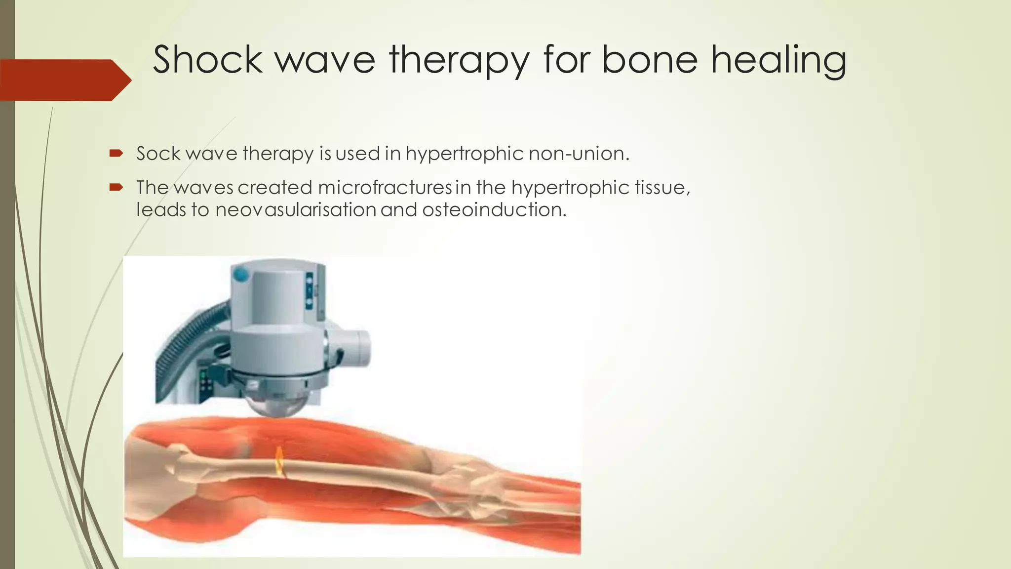 Stages of Bone healing and madalities to enhance bone healing | PDF