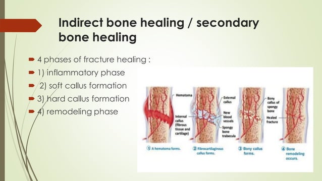 Stages of Bone healing and madalities to enhance bone healing