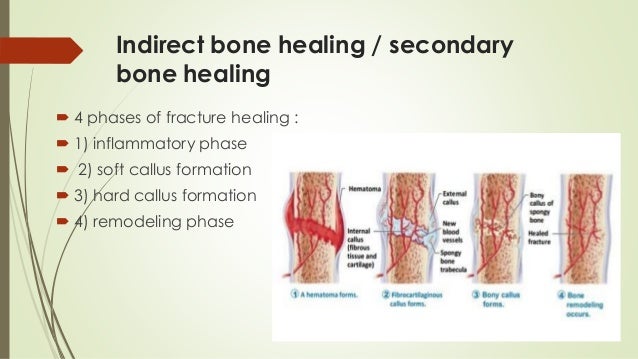Stages of Bone healing and madalities to enhance bone healing